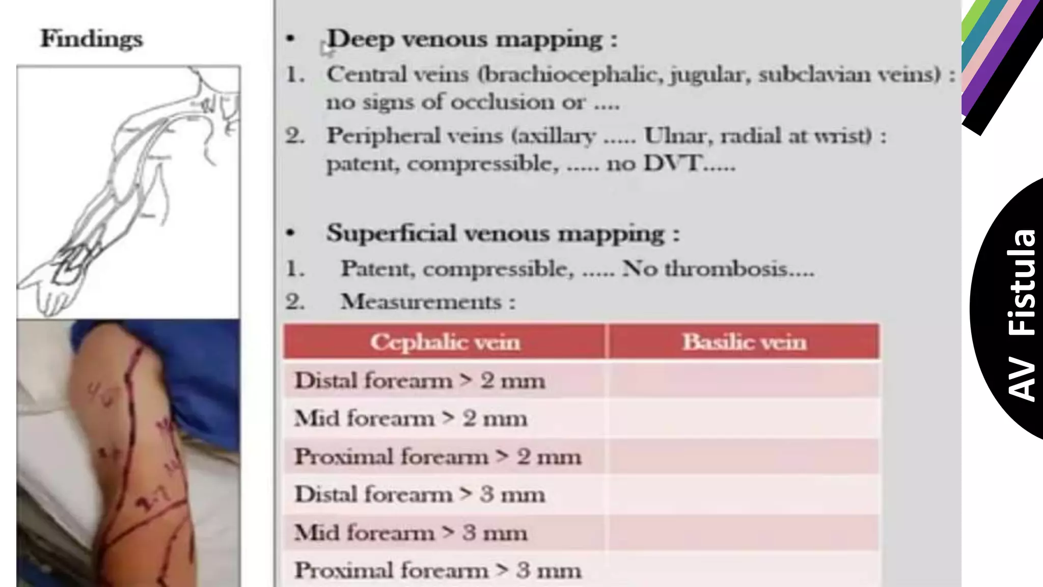 Role of USG in A-V fistula assessment | PPTX