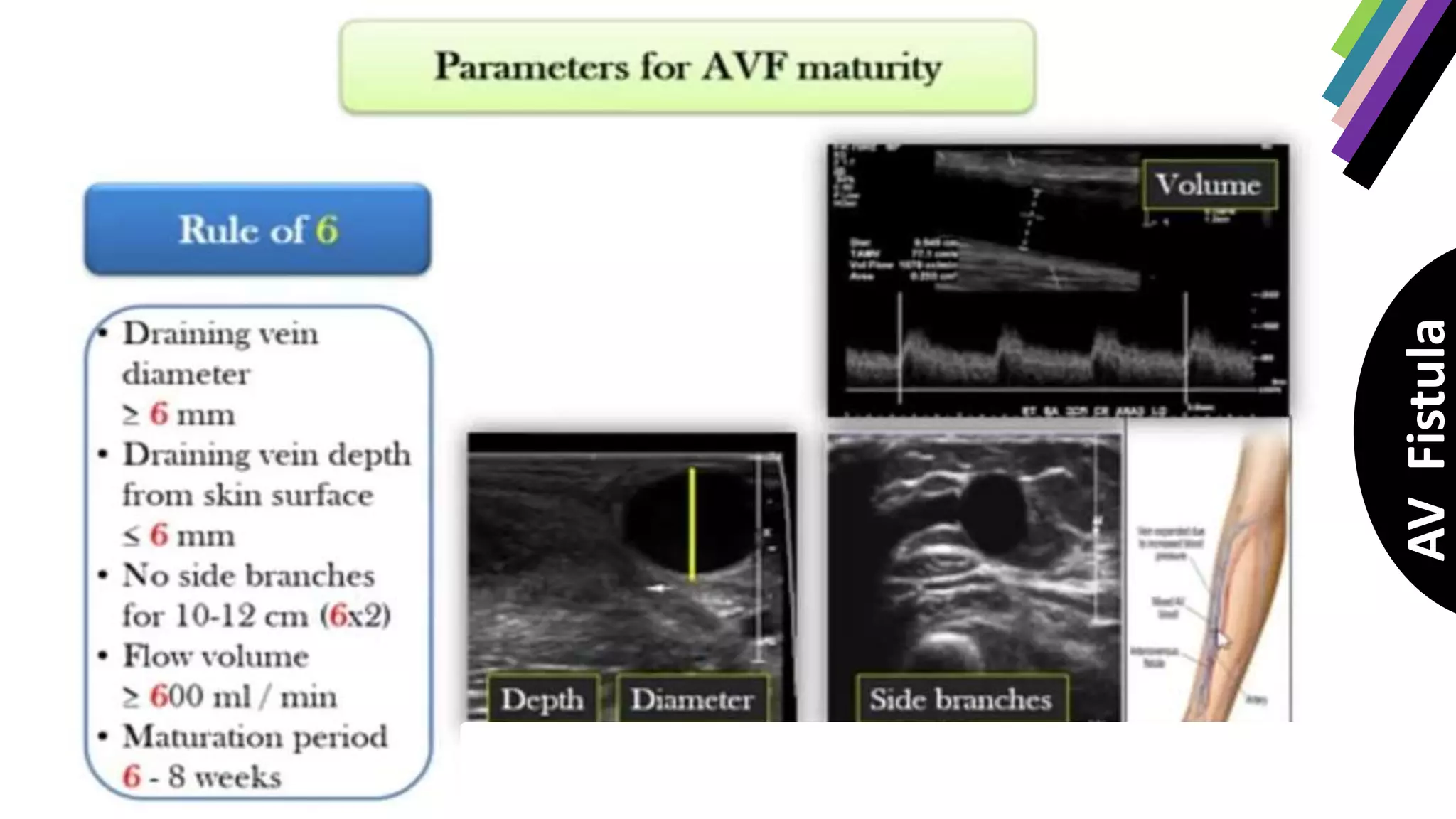Role of USG in A-V fistula assessment | PPTX