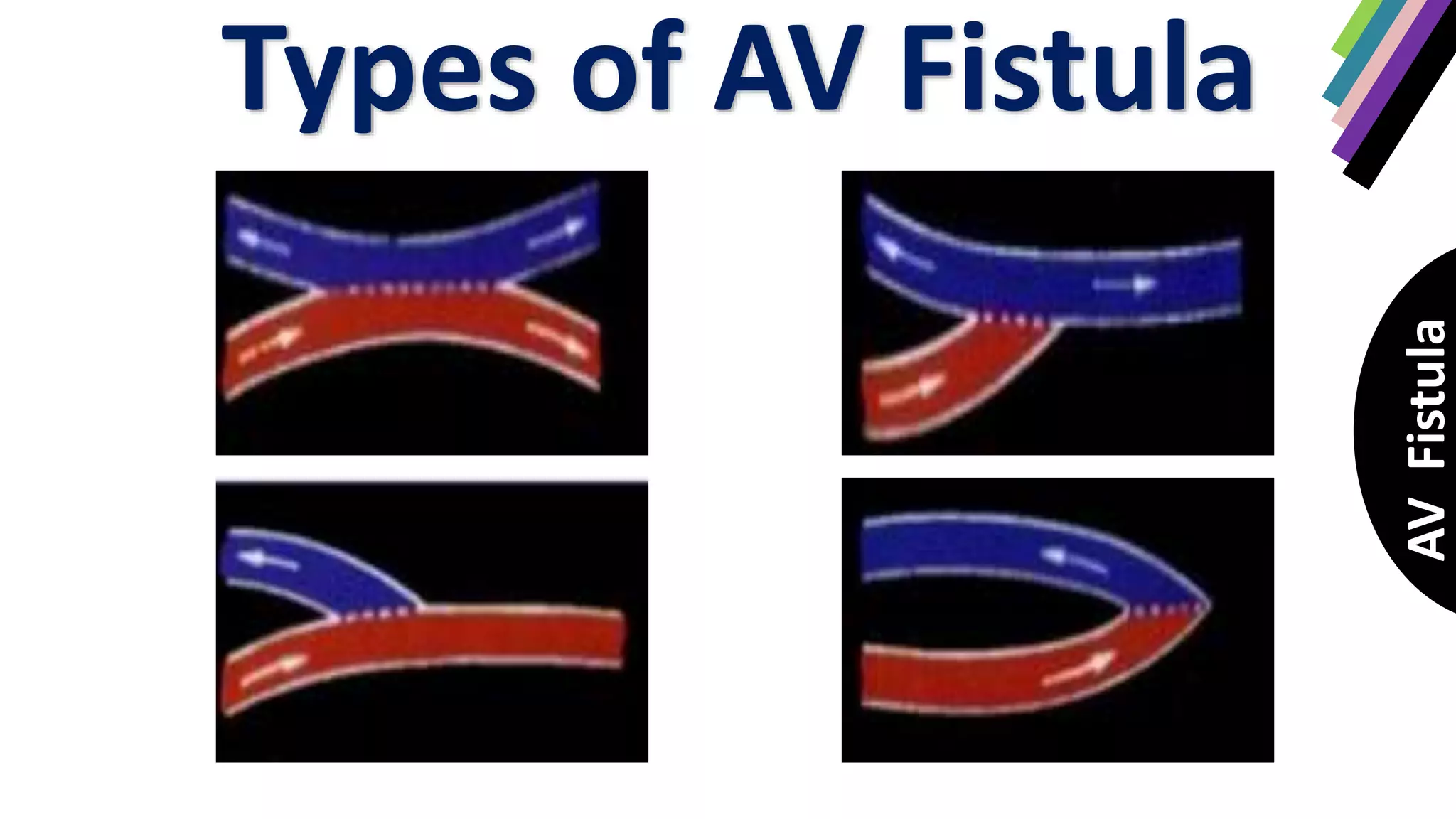 Role of USG in A-V fistula assessment | PPTX