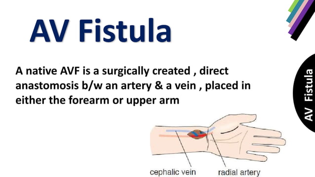 Role of USG in A-V fistula assessment | PPTX