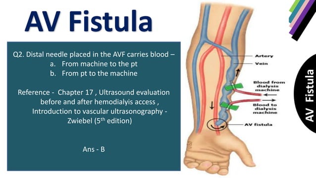 Role of USG in A-V fistula assessment