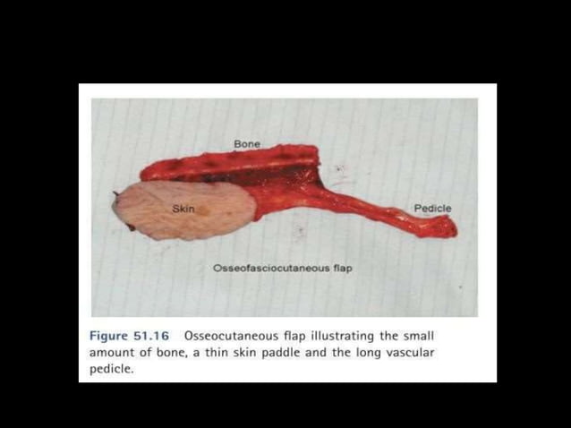 reconstructive microsurgery in head & neck defect based reconstruction.pptx