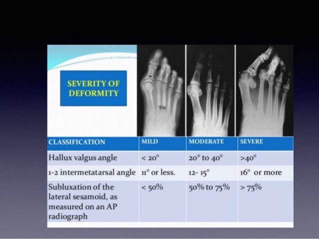 Final hallux valgus pp