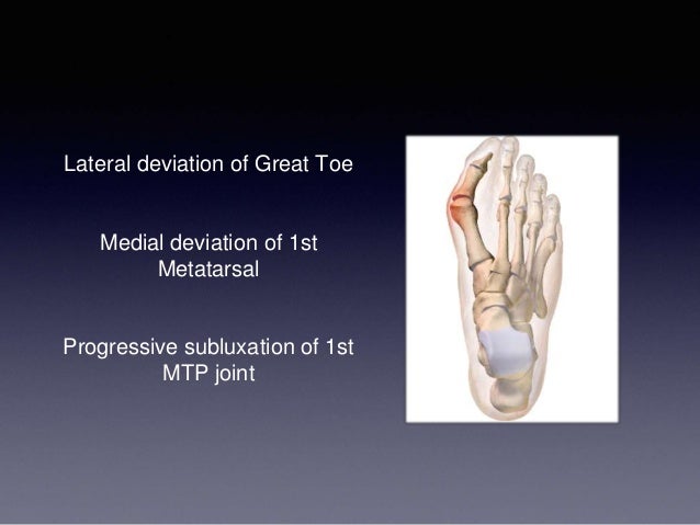 Final hallux valgus pp
