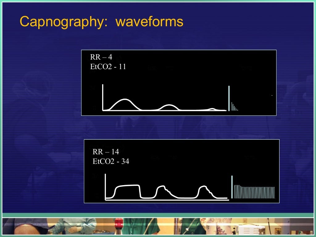 CC - EtCO2 and Waveform Capnography