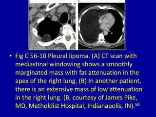 56 fat containing lesions of the chest | PPTX | Lung and Respiratory ...
