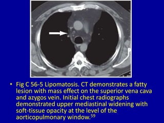 56 fat containing lesions of the chest | PPTX | Lung and Respiratory ...