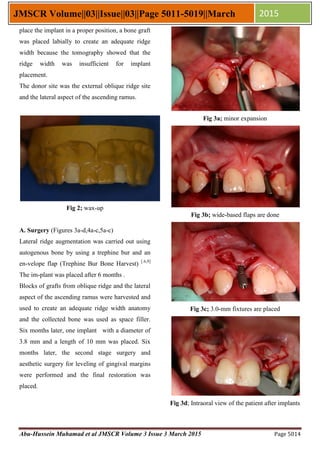 Management of Congenitally Missing Lateral Incisors with Orthodontics ...