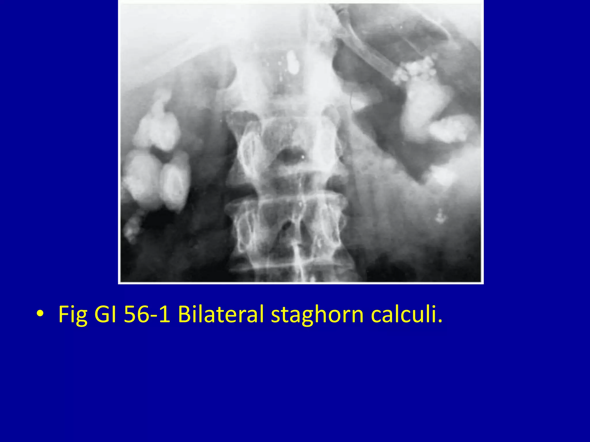 56 renal calcification | PPTX