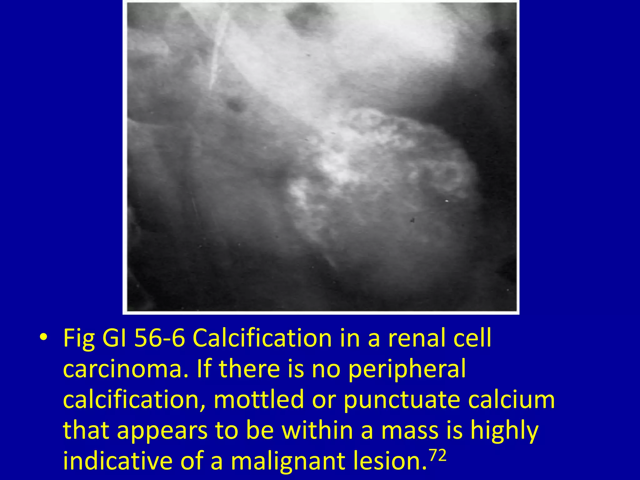 56 renal calcification | PPTX