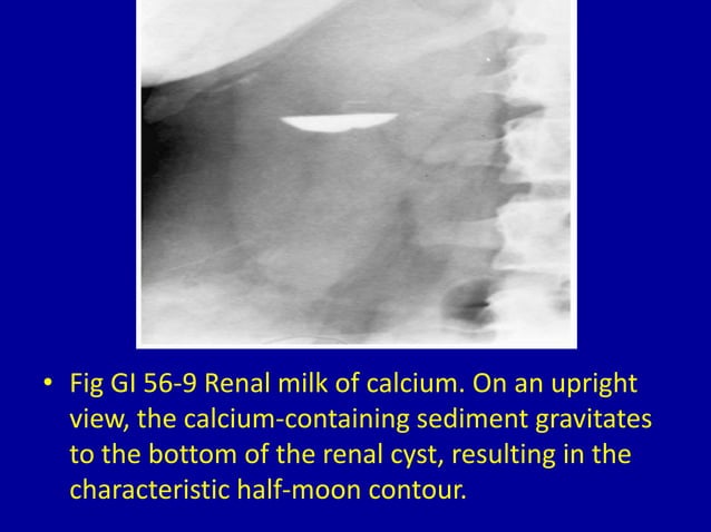 56 renal calcification | PPTX
