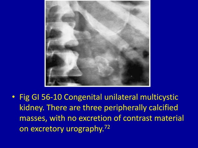 56 renal calcification | PPTX