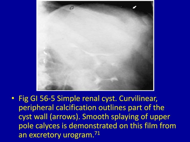56 renal calcification | PPTX