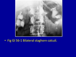 56 renal calcification | PPTX