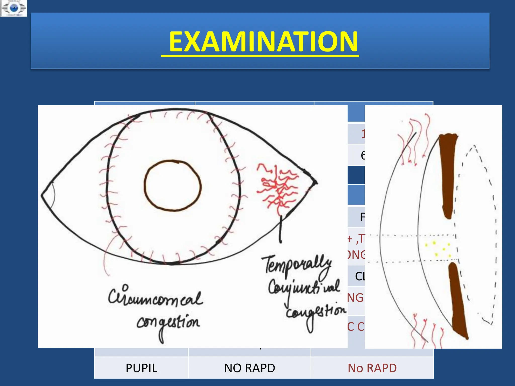 POSTERIOR_SCLERITIS presentation dhb.pptx