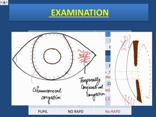 POSTERIOR_SCLERITIS presentation dhb.pptx