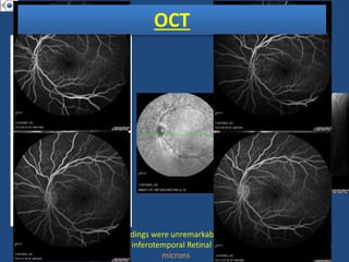 POSTERIOR_SCLERITIS presentation dhb.pptx