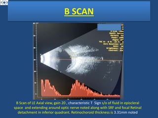 POSTERIOR_SCLERITIS presentation dhb.pptx