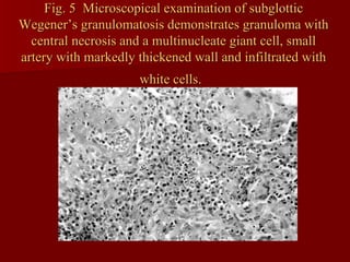 5749 Endoscopic Laser Surgery For Subglottic Stenosis In Wegeners ...