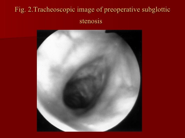 5749 Endoscopic Laser Surgery For Subglottic Stenosis In Wegeners Gra…