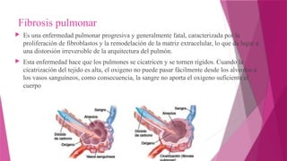 575225782-Fibrosis-Pulmonar presentacion.pdf