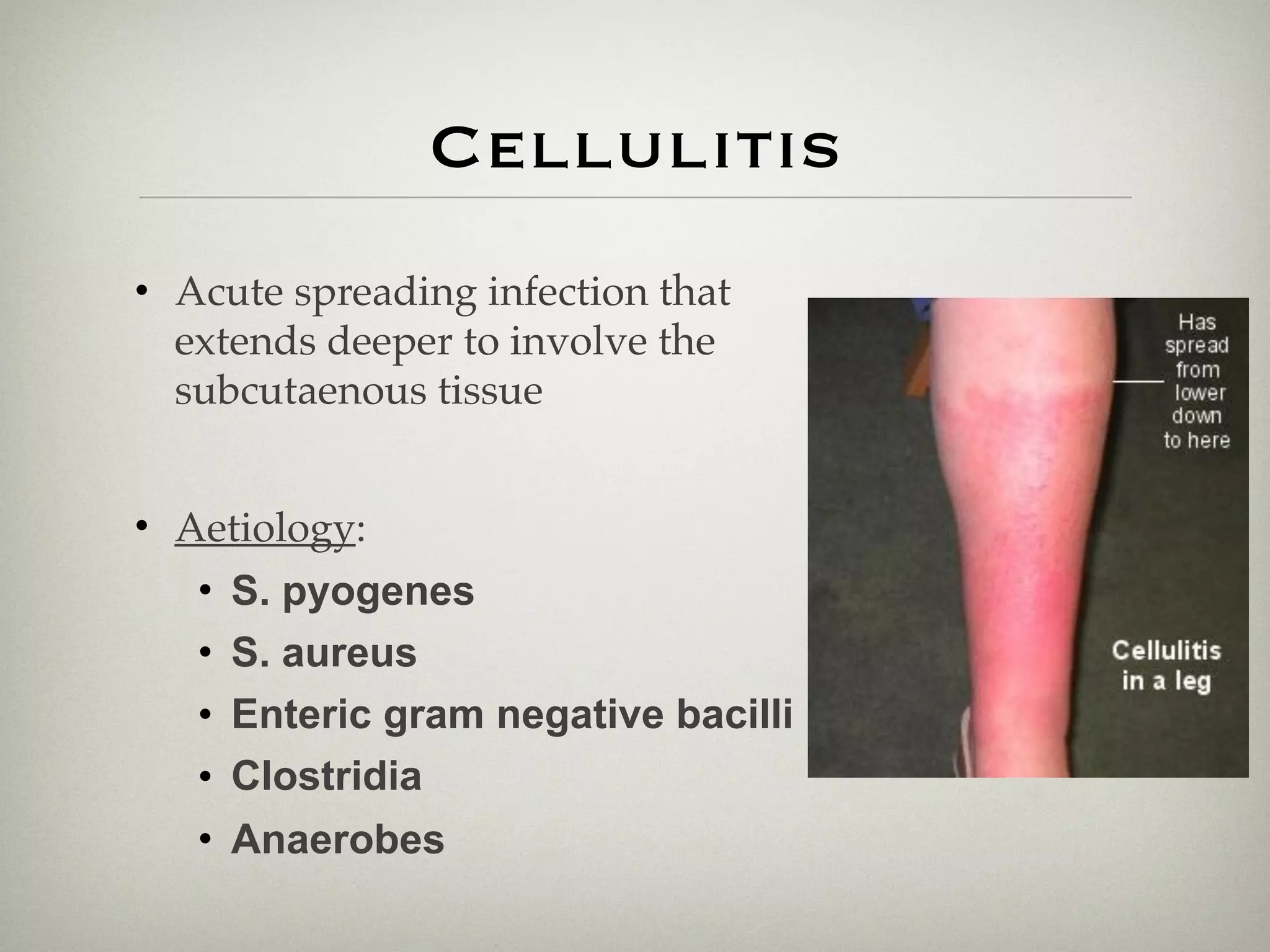 Skin and Soft Tissue Infections | PDF