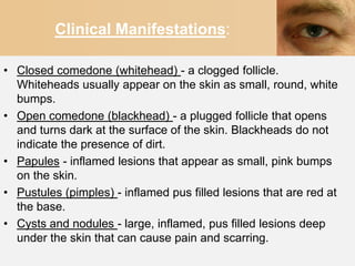 acne vulgaris | PPTX