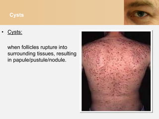 acne vulgaris | PPTX