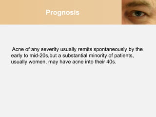 acne vulgaris | PPTX