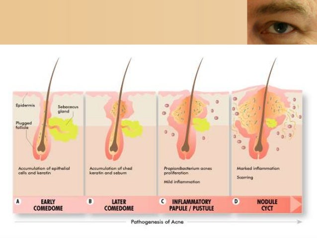 acne vulgaris