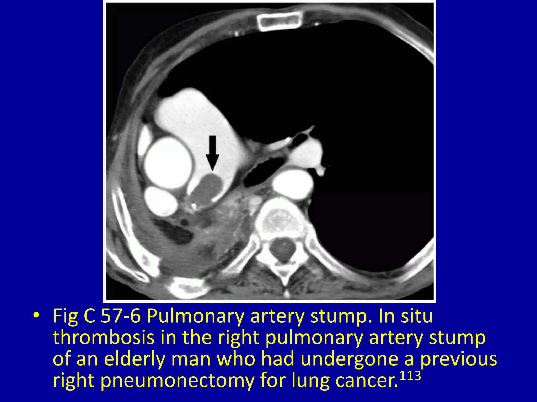 57 filling defect in pulmonary artery on computed | PPTX