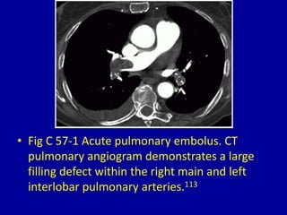 57 filling defect in pulmonary artery on computed | PPTX