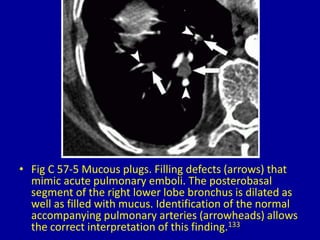 57 filling defect in pulmonary artery on computed | PPTX