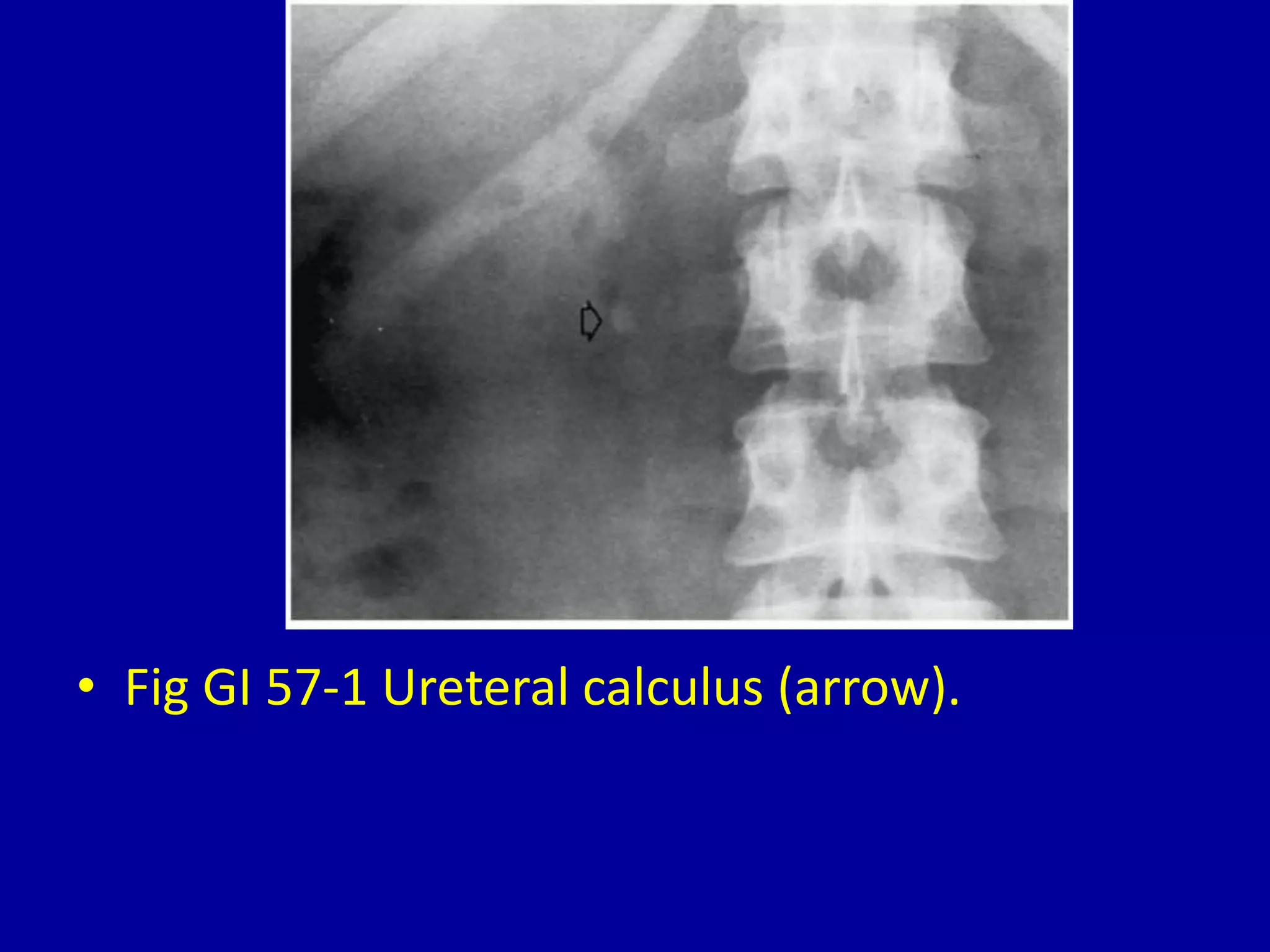57 ureteral calcification | PPTX