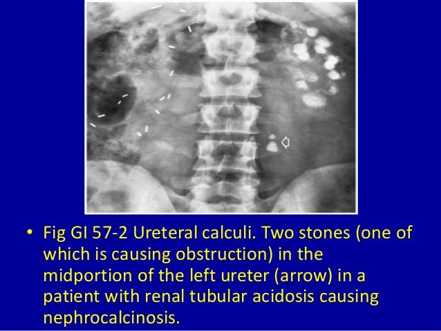 57 ureteral calcification