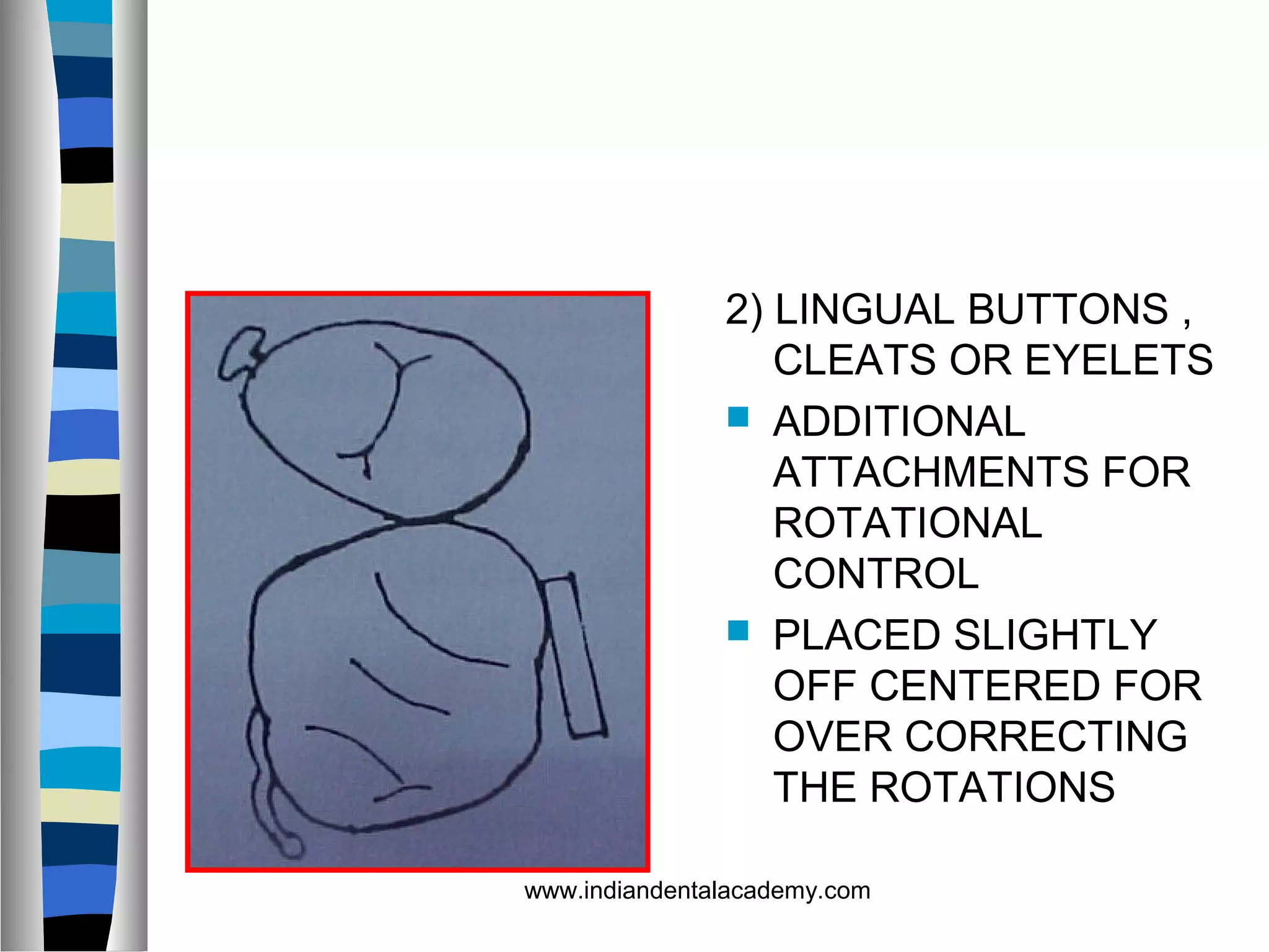 Refined begg technique | PPT