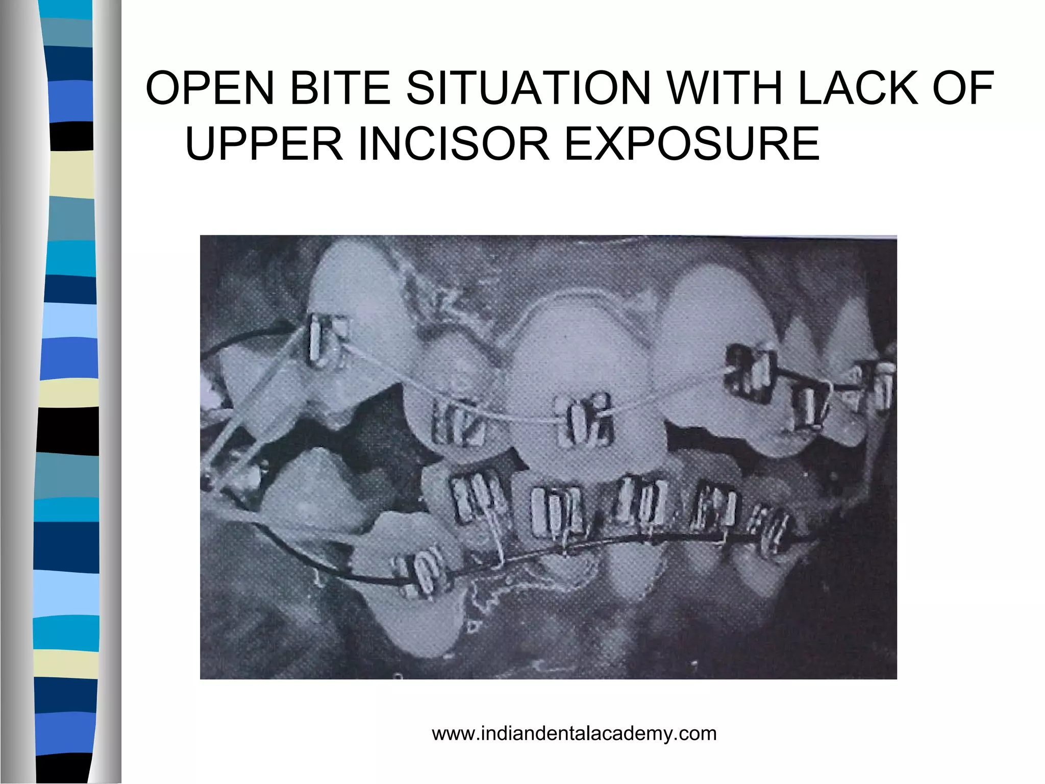 Refined begg technique | PPT