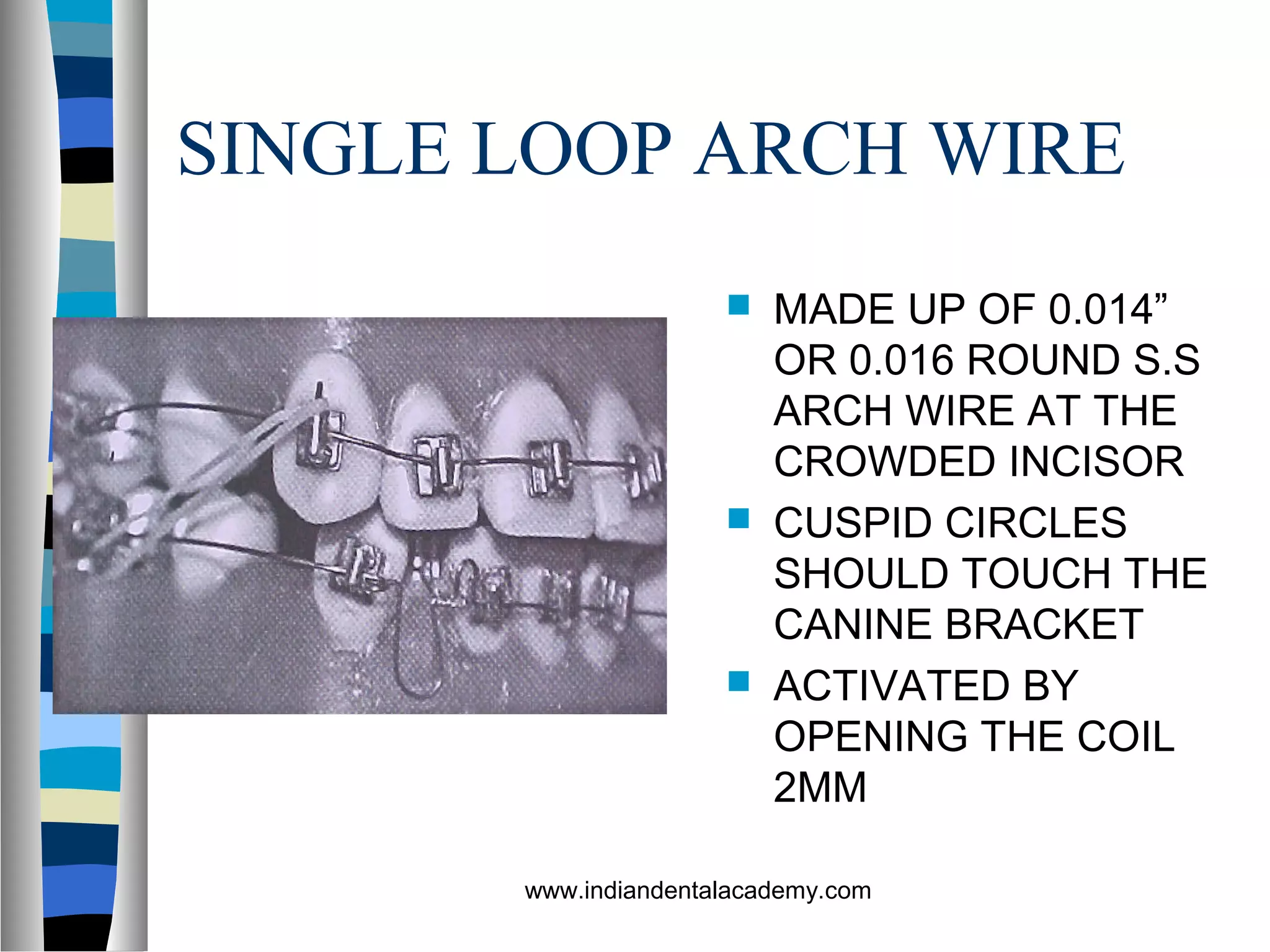 Refined begg technique | PPT
