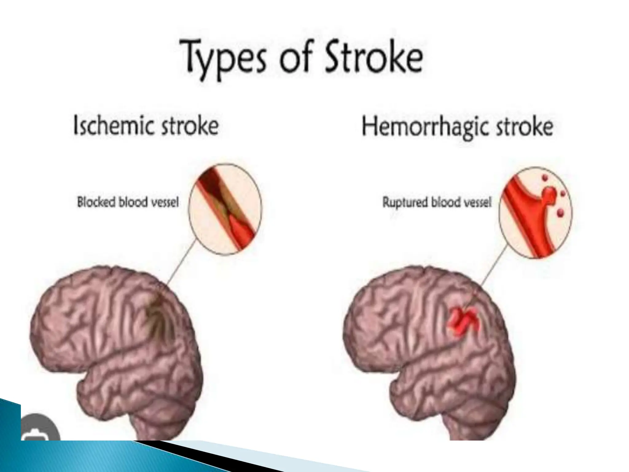 58.STROKE AND ITS CLASSIFICATION ON THE BASIS OF.pptx