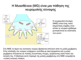 Klinikh Eikona ths Myasthenias - Amelia Evoli (Greek) | PPS