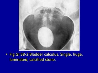 58 bladder calcification | PPT