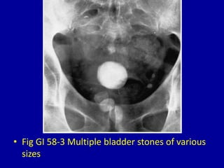 58 bladder calcification | PPT