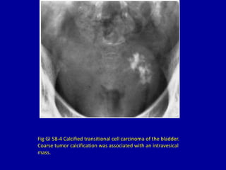 58 bladder calcification | PPT