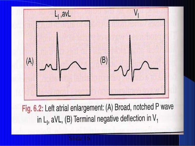 ECG