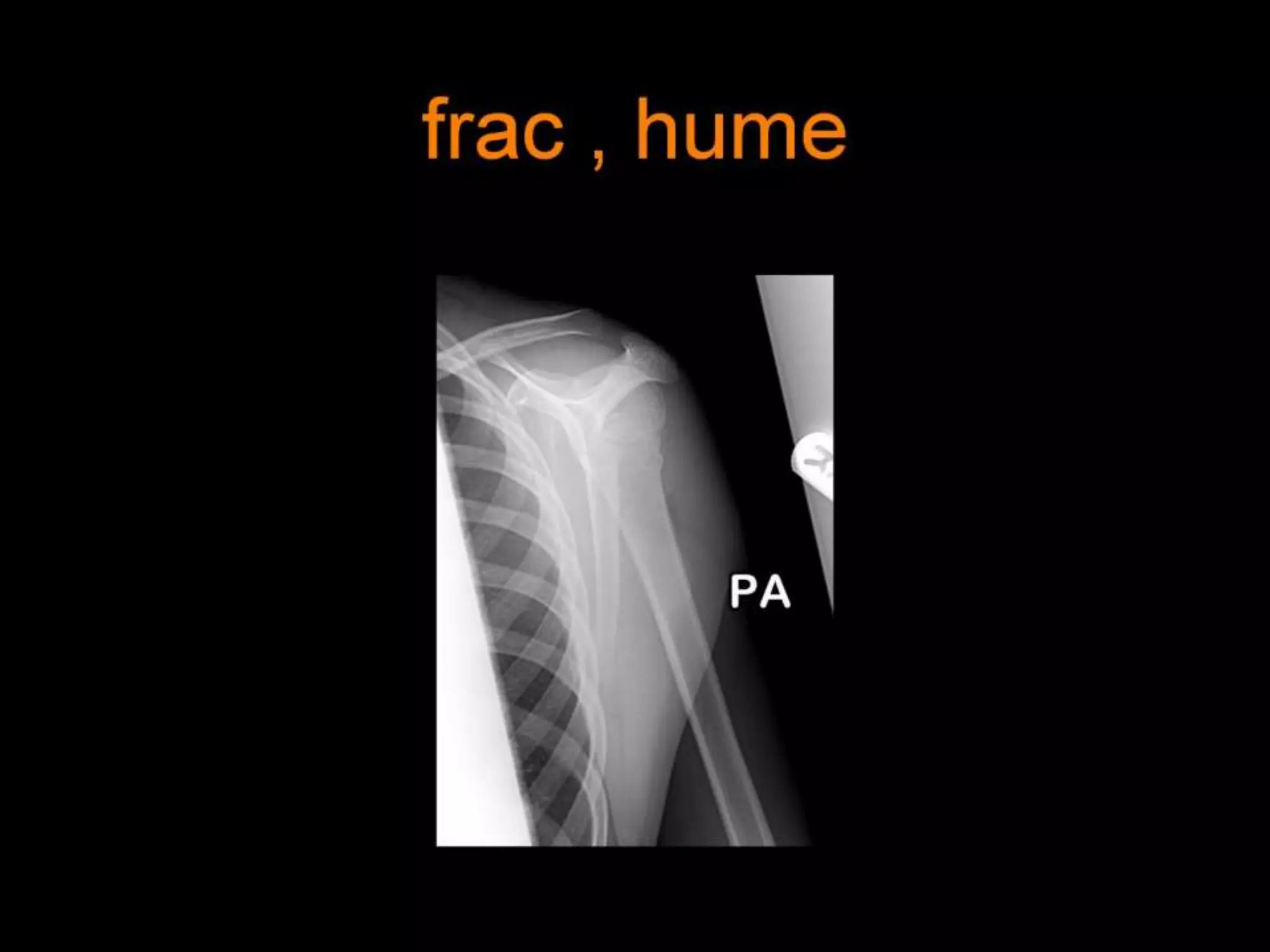 59-Dr Ahmed Esawy imaging oral board MSK imaging part V fracture B | PPT