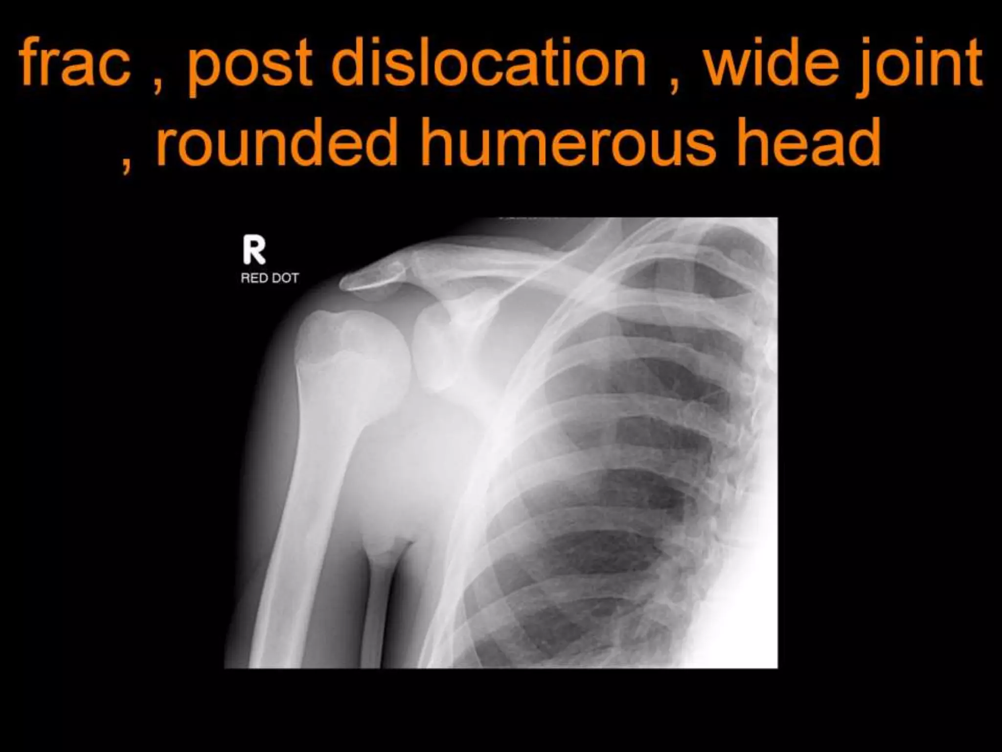 59-Dr Ahmed Esawy imaging oral board MSK imaging part V fracture B | PPT