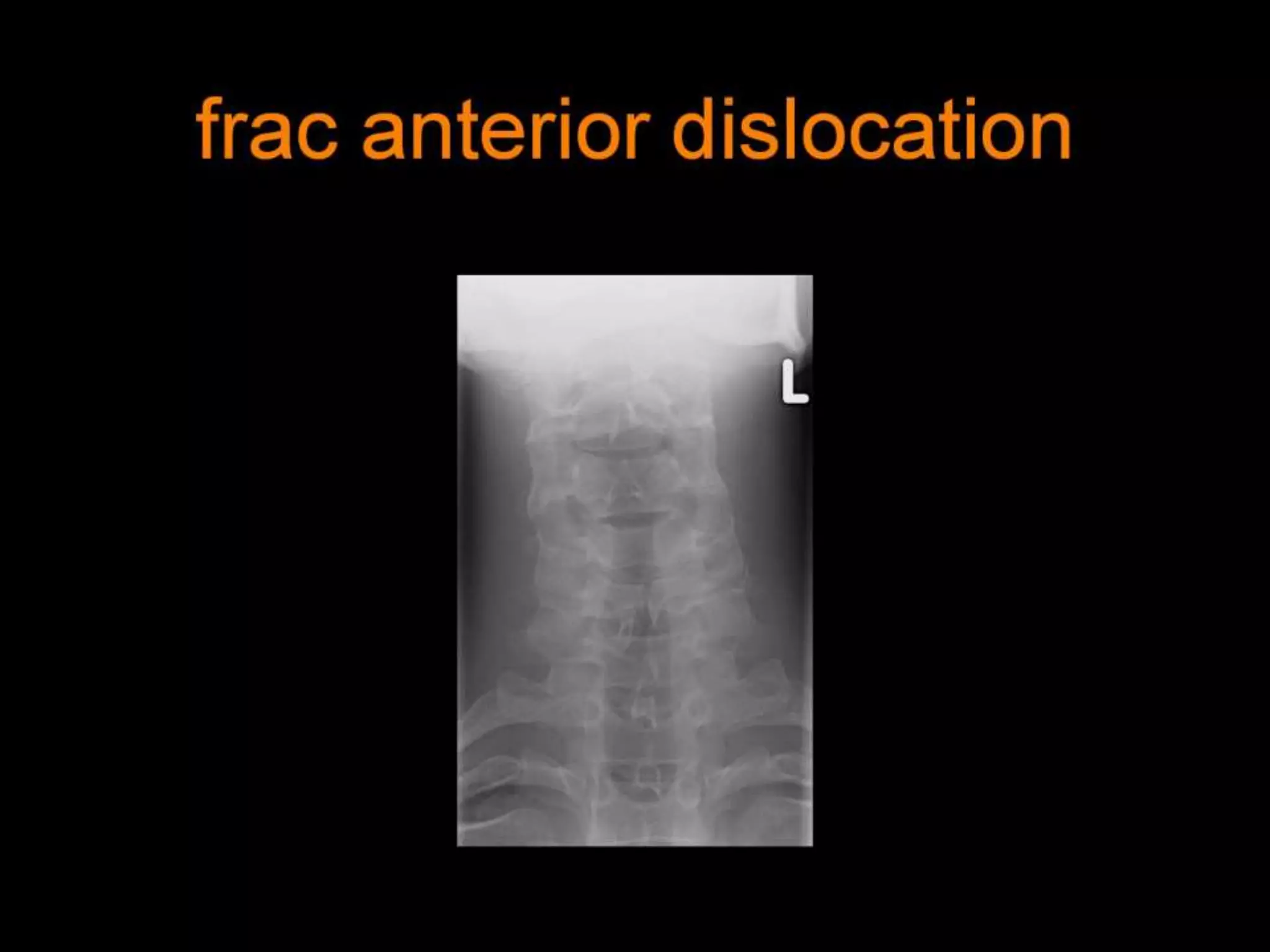 59-Dr Ahmed Esawy imaging oral board MSK imaging part V fracture B | PPT