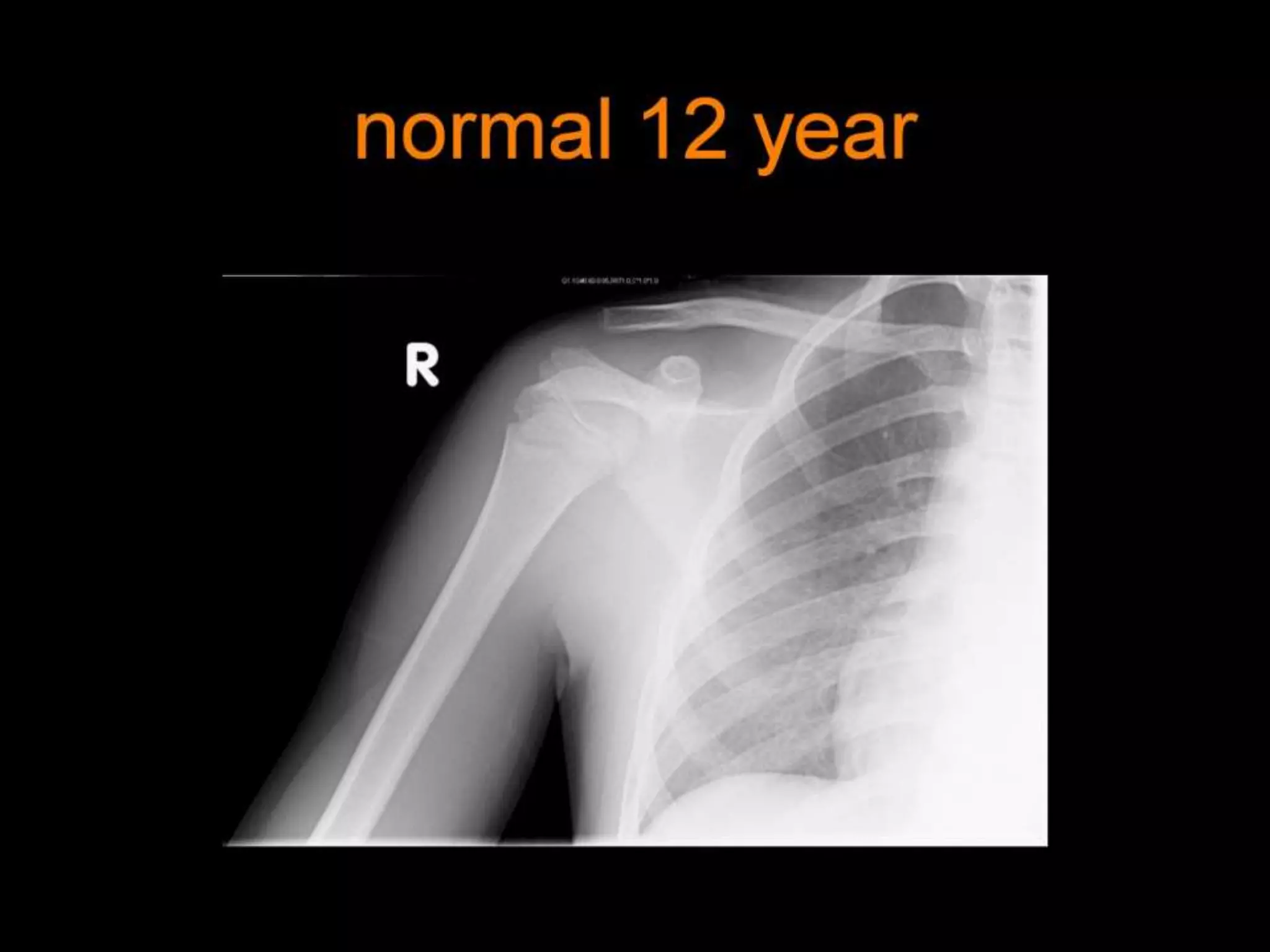 59-Dr Ahmed Esawy imaging oral board MSK imaging part V fracture B | PPT