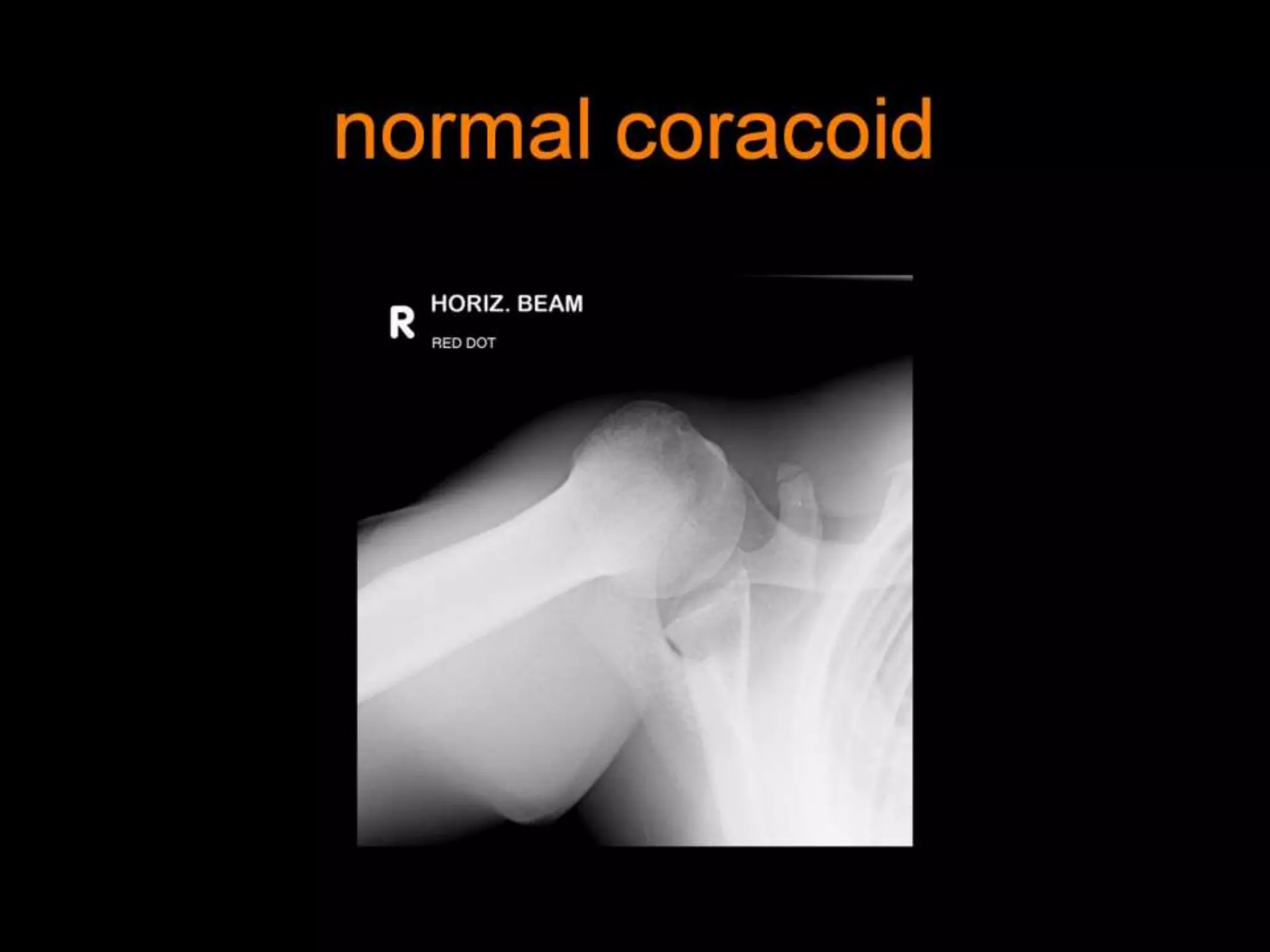 59-Dr Ahmed Esawy imaging oral board MSK imaging part V fracture B ...