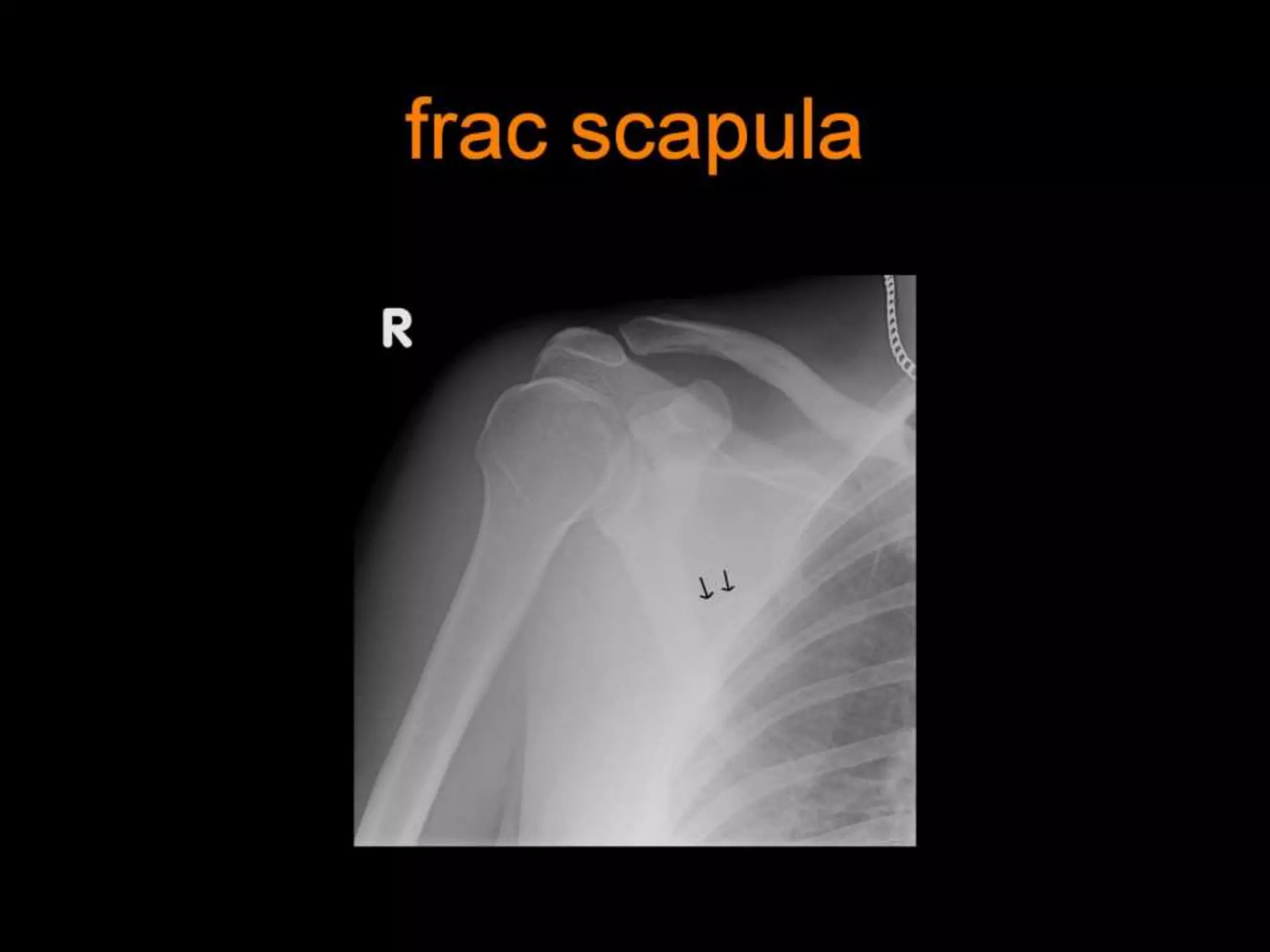 59-Dr Ahmed Esawy imaging oral board MSK imaging part V fracture B | PPT